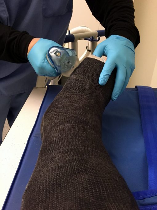 Cast removal: See how it's done, step-by-step - Lilyvolt